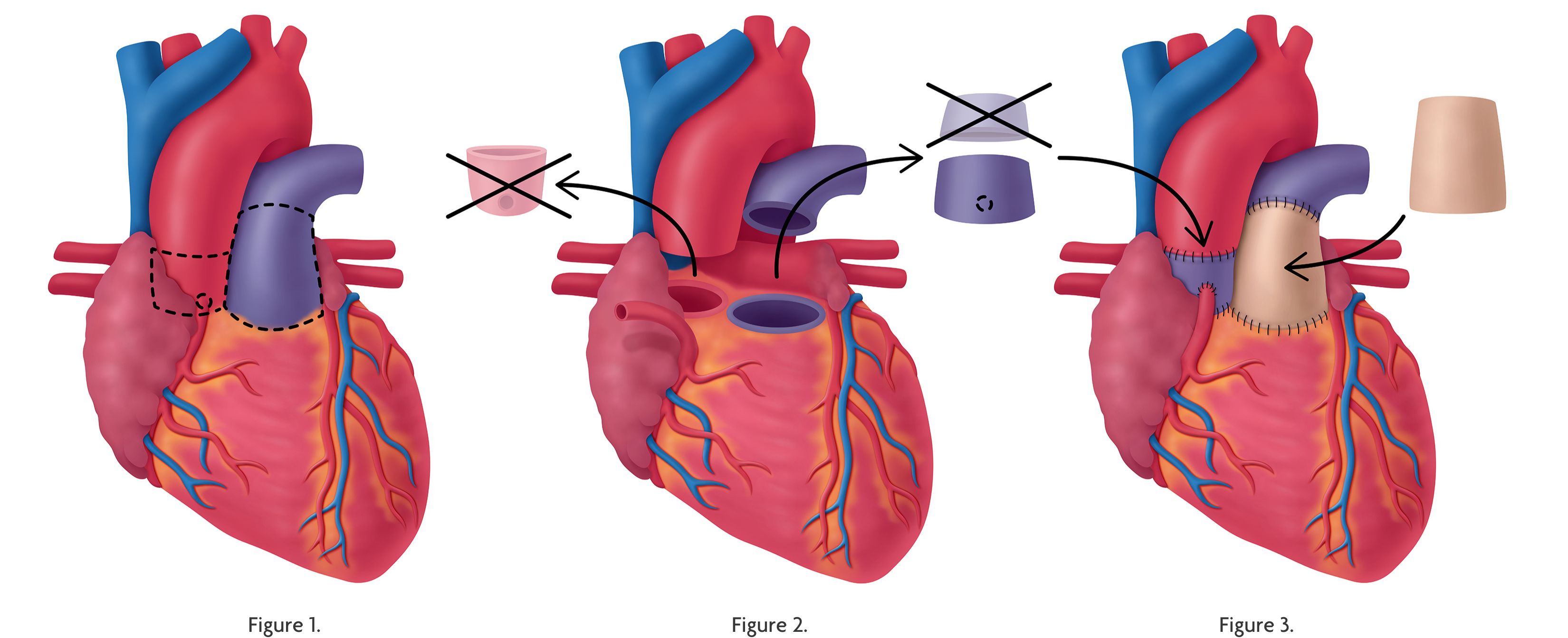 The Ross Procedure LifeNet Health The Ross Procedure LifeNet Health